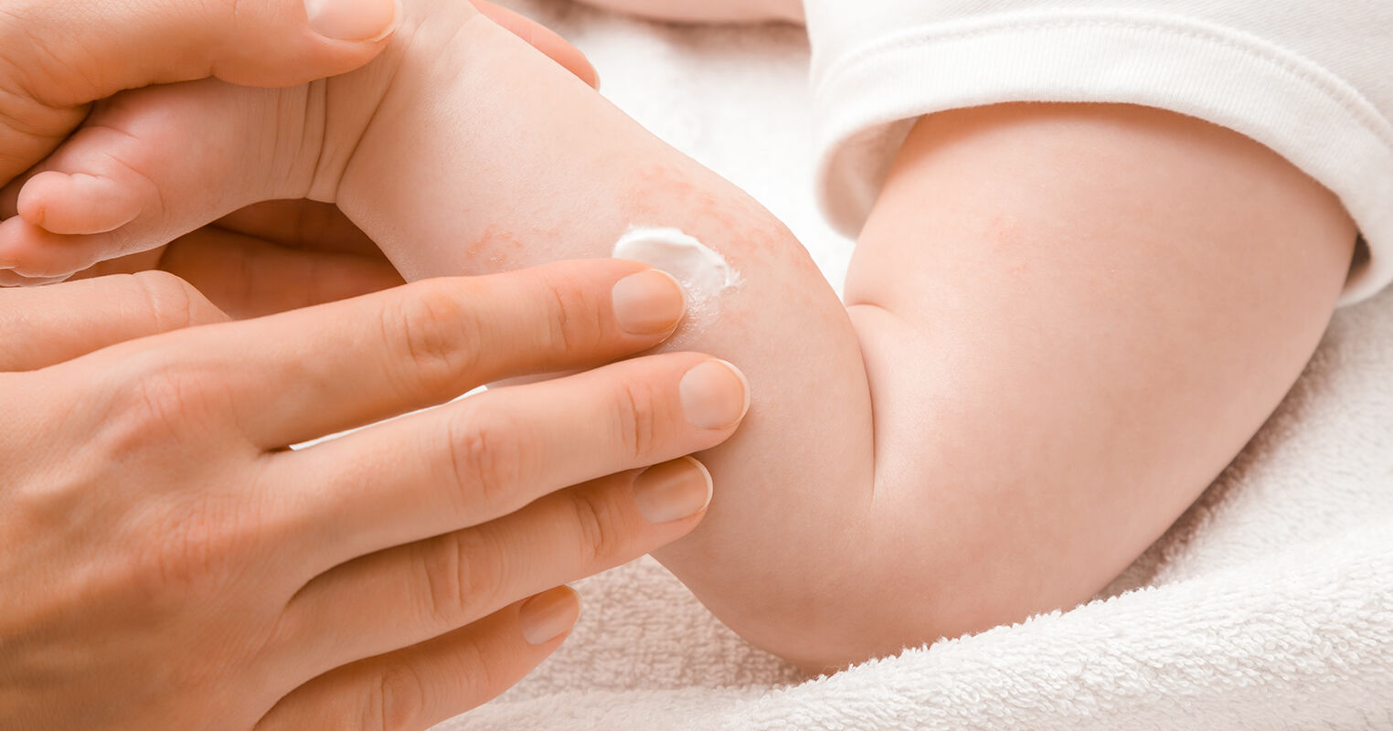 Cream for Baby Eczema or Atopic Dermatitis | Cetaphil NZ